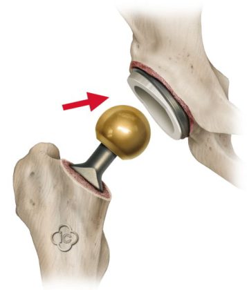 Advantages and Disadvantages of a Ceramic Hip-Replacement - Mencoret ...